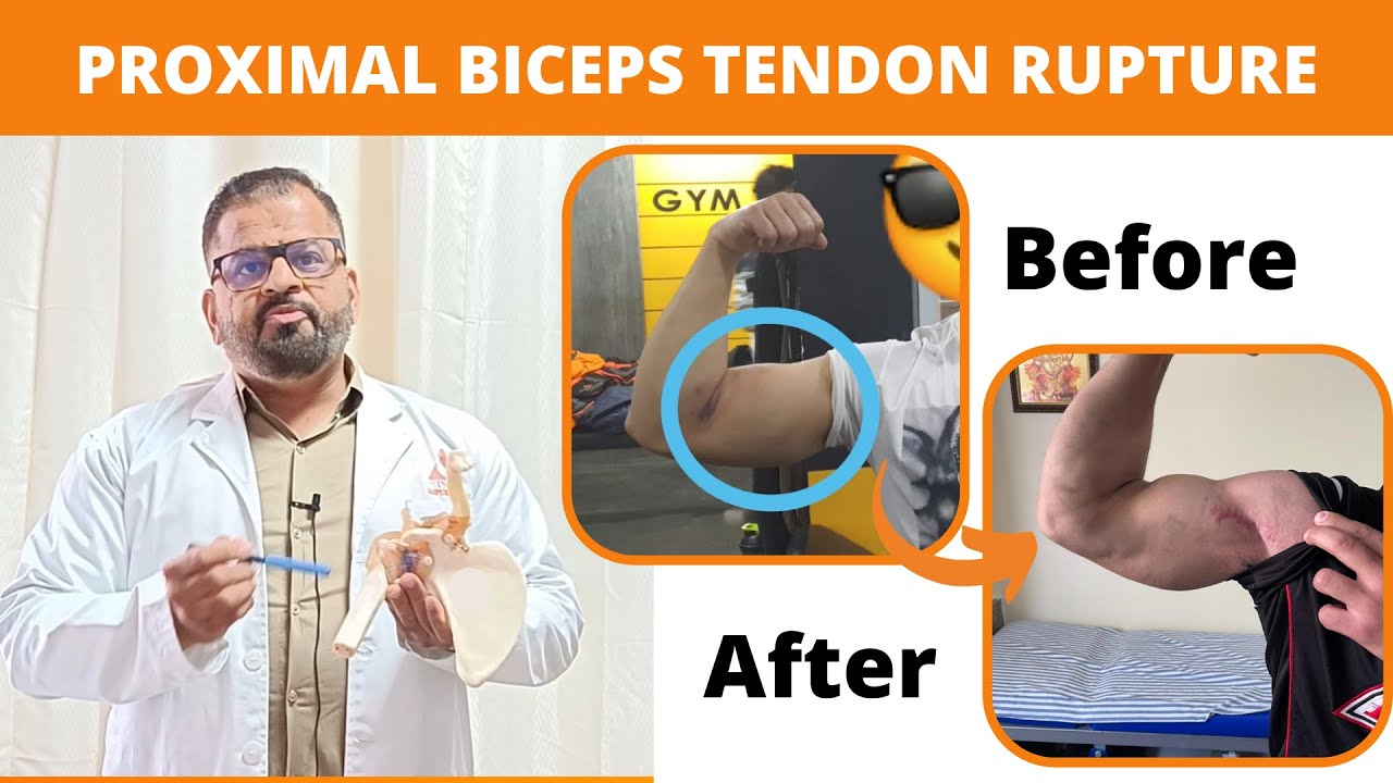 Biceps Tendon Rupture | Heavy weight lifting injury | Dr. Dilip Mehta ...