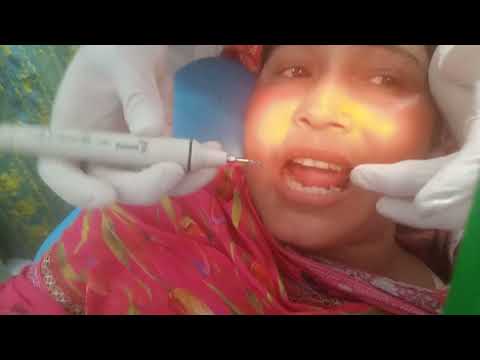 lower left and right side premolar and molar root canal procedure step ...
