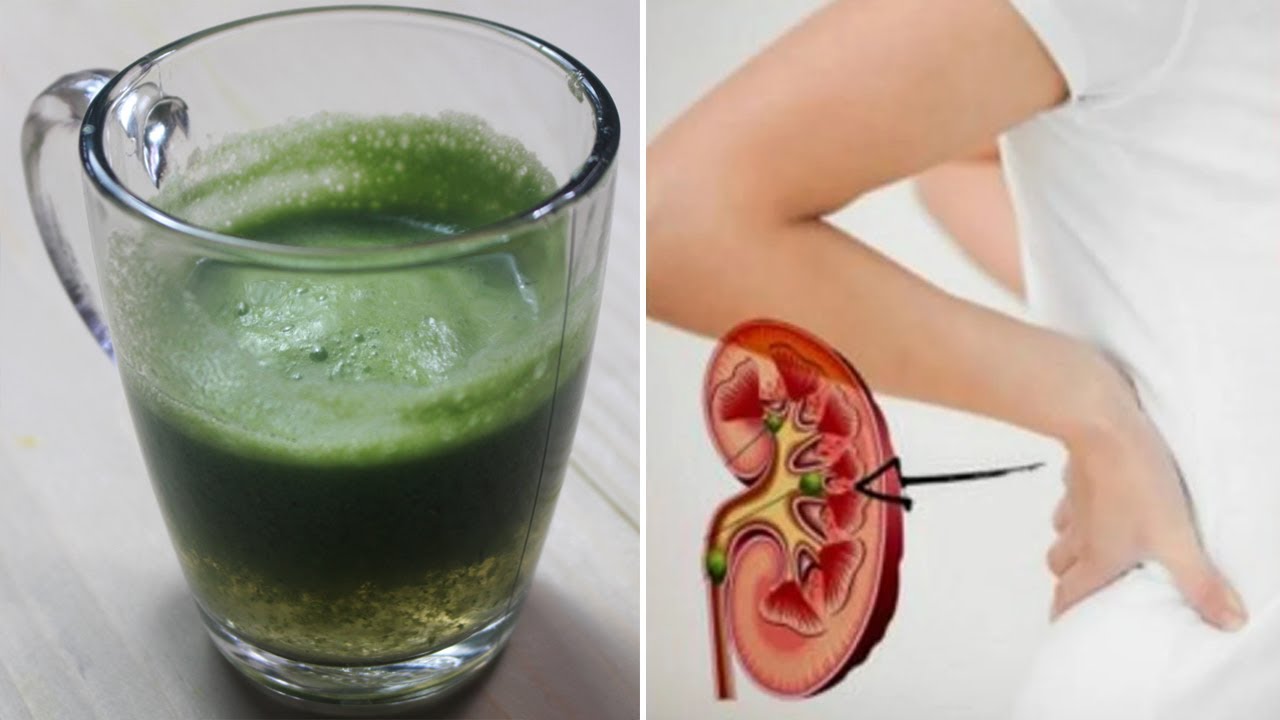 Păstrează-ți rinichii sănătoși si previn pietrele la rinichi cu un ...