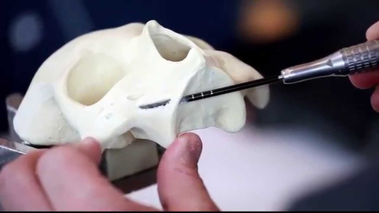 Zygomatic Implants Pterygoid implants | FOR.org