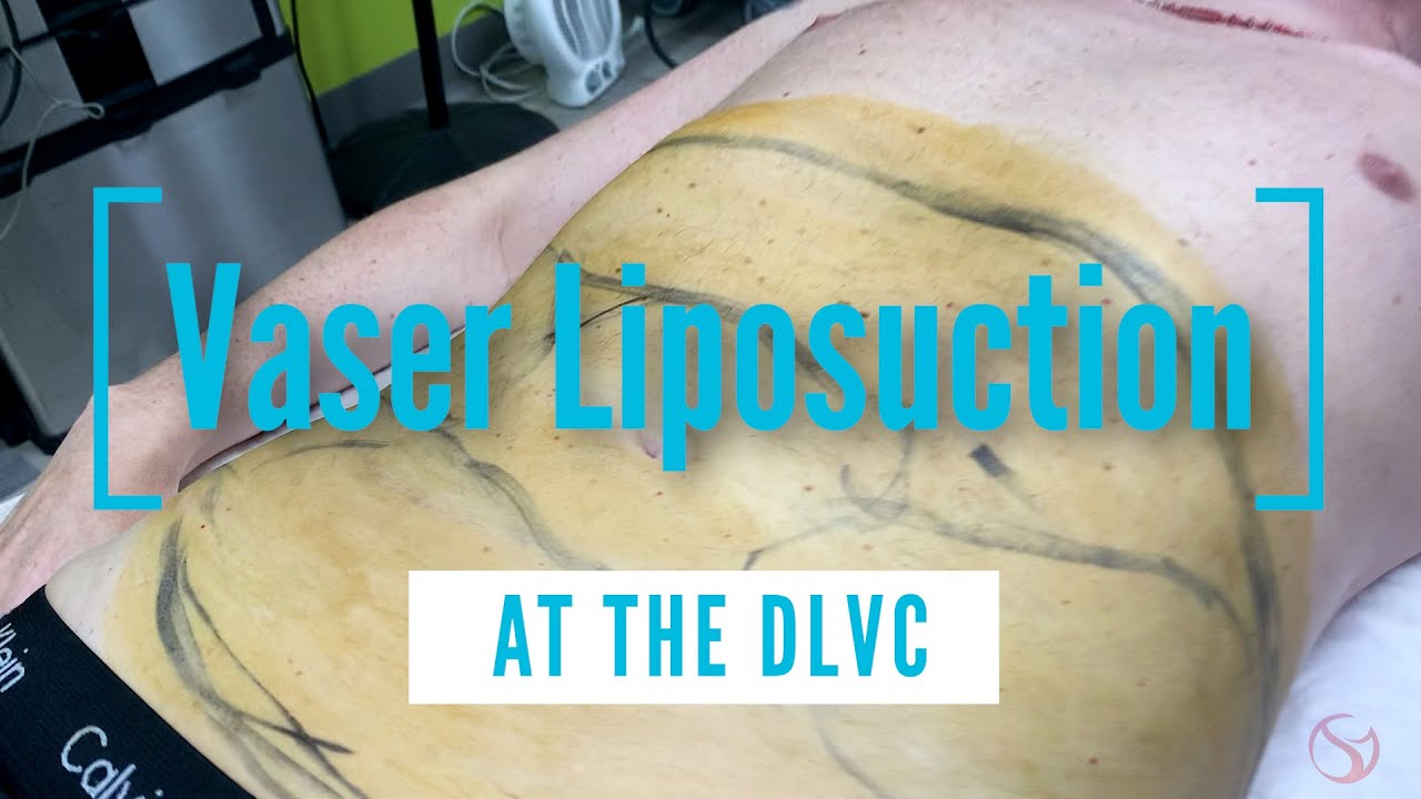 Interview with a Vaser Liposuction Patient at the DLVC - YouTube