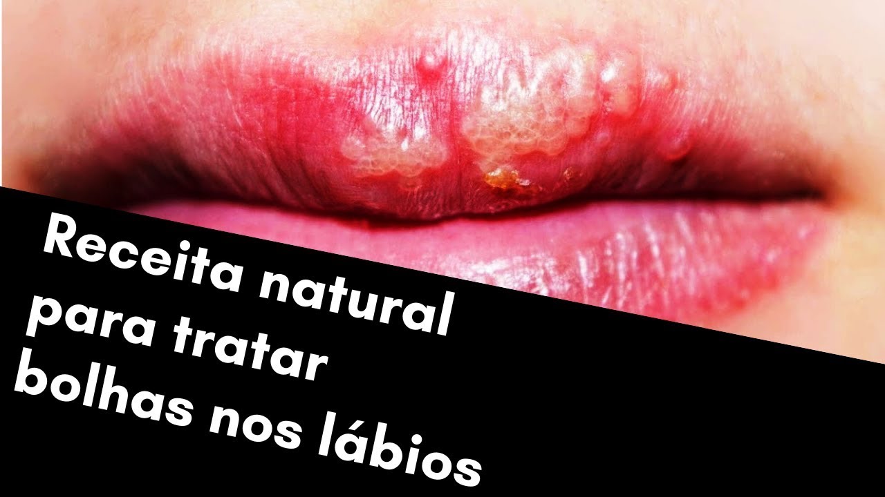 Receita natural para tratar bolhas nos lábios... - YouTube