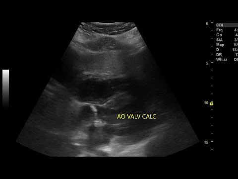 Normal vs abnormal aortic valve, subcostal vs PLAX view ...