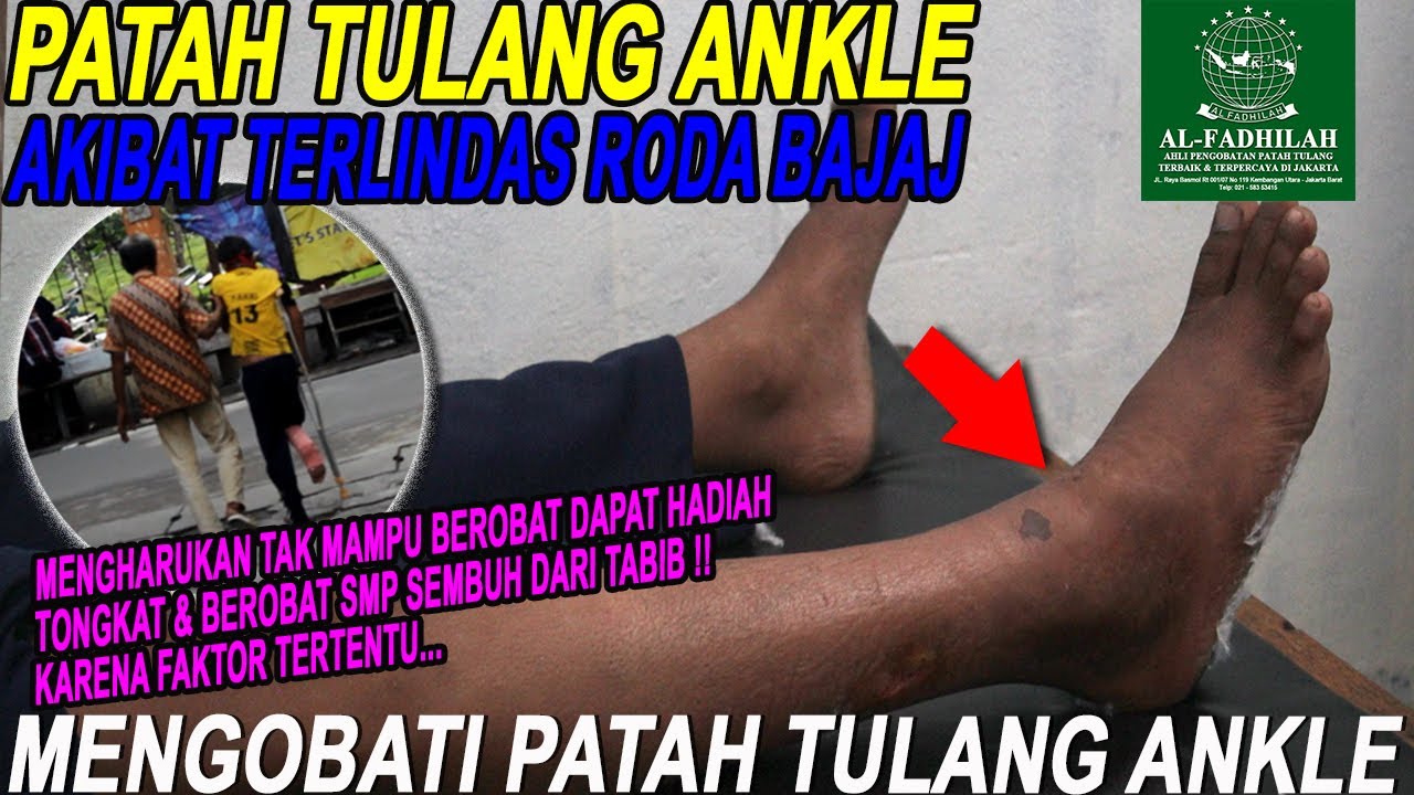 MENGHARUKAN !! PATAH PERGELANGAN KAKI (ANKLE BONE FRACTURE ...