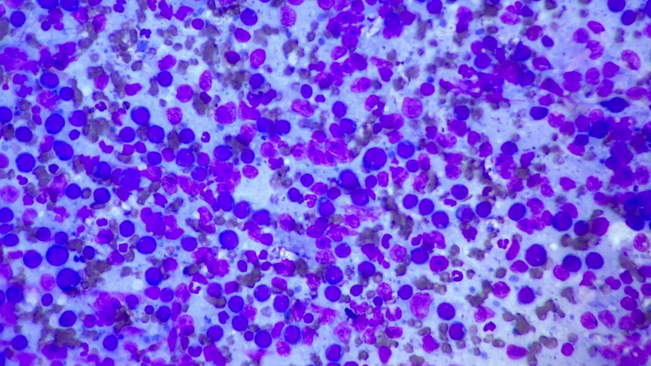 Splenic Lymphoma cytology - YouTube