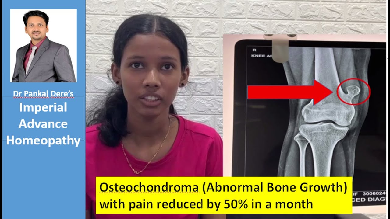 Abnormal bone growth #kneepain #arthritis reduced by #homeopathy # ...