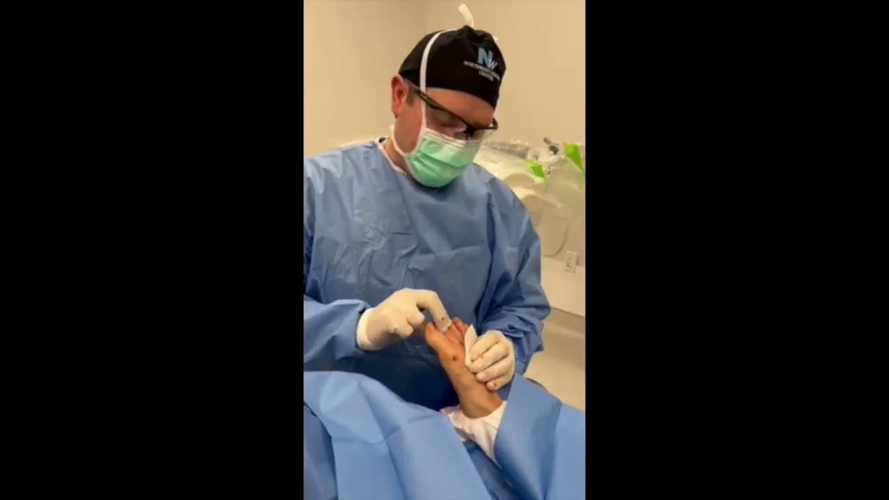 Minimally Invasive Hammertoe Surgery: From Start to Finish - YouTube