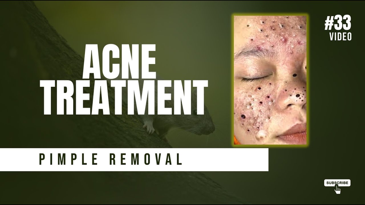 Pimple Popping And Skin Care big pimples blackheads whiteheads Health ...