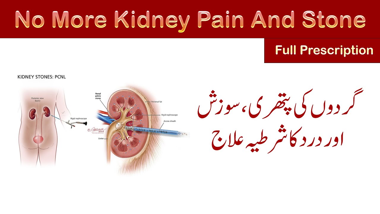 Gurday ki dard aur pathri ka ilaj | Kidney Pain And Stone | گردے کے درد ...