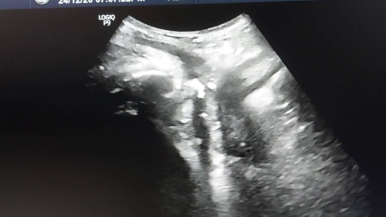 approach to prostatic urethral calculus in urinary retention - YouTube