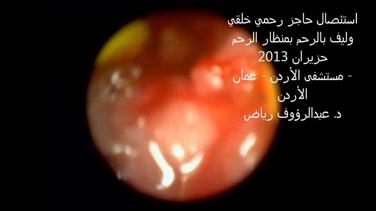 Hysteroscopic resection of uterine septum - YouTube