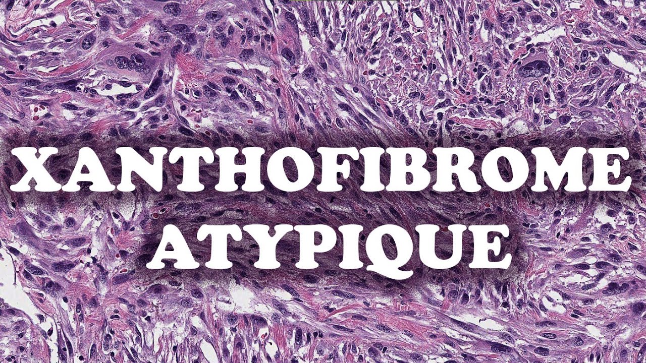 LE FIBROXANTHOME ATYPIQUE - PATHOLOGIE - YouTube