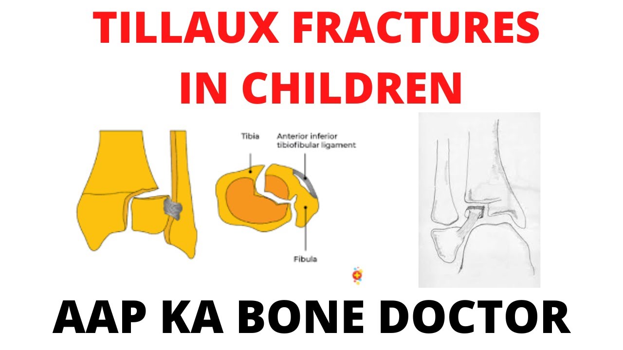 TILLAUX FRACTURES IN CHILDREN - EPISODE 57 - YouTube