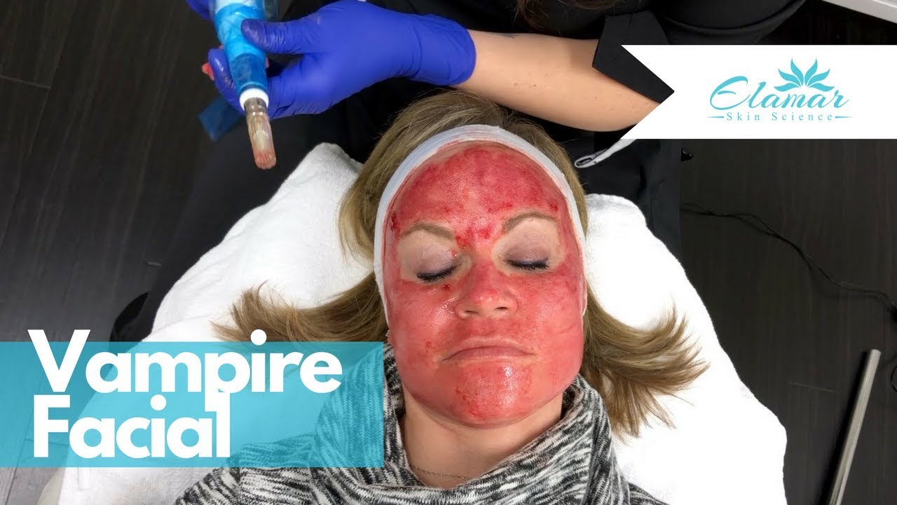 Vampire Facial® | What to Expect During Yours - YouTube