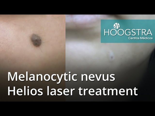 Melanocytic Nevus Congenital Melanocytic Nevus (CMN), Medium Size.