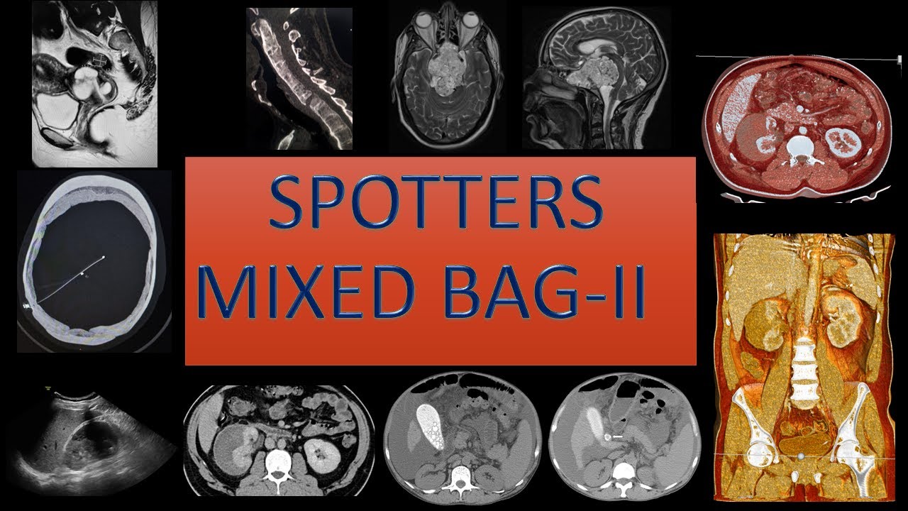 SPOTTERS MIXED BAG SET II - YouTube
