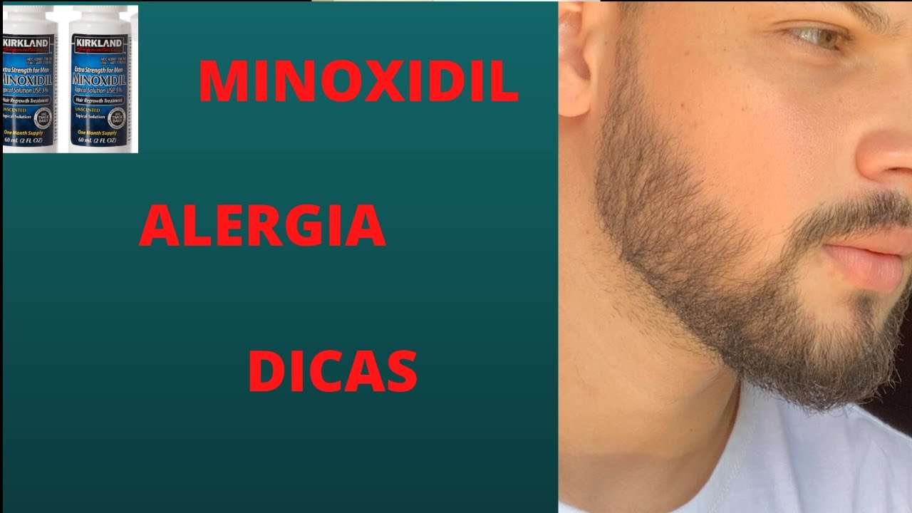 MINOXIDIL: Dicas de uso, para quem tem alergia. - YouTube