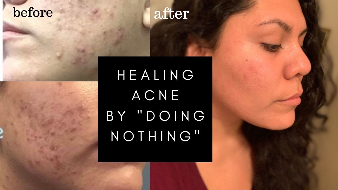 How I Healed My Acne By "Doing Nothing" - YouTube