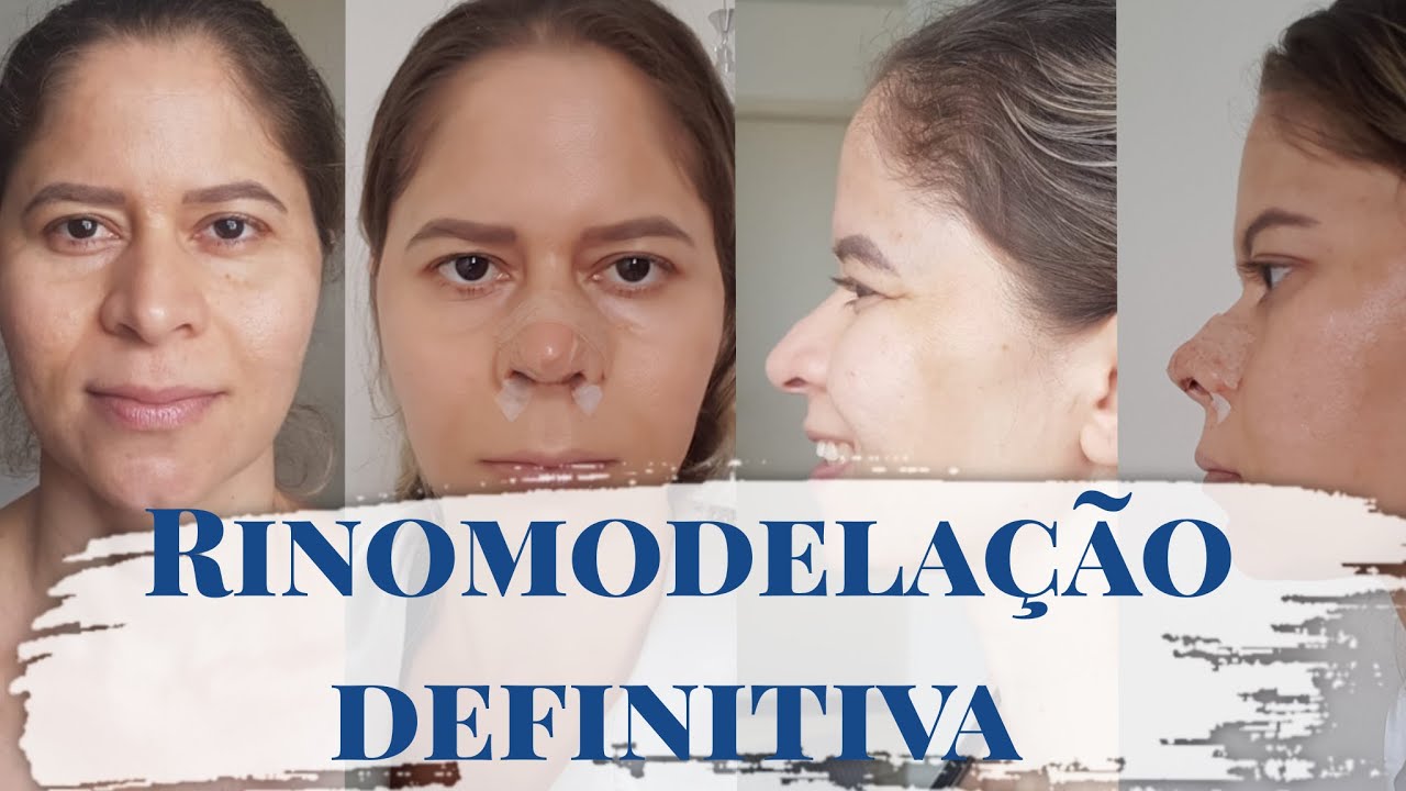 Rinomodelação definitiva - YouTube