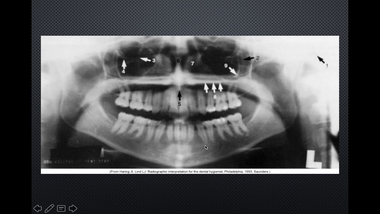 Normal Panoramic Interpretation Source - YouTube