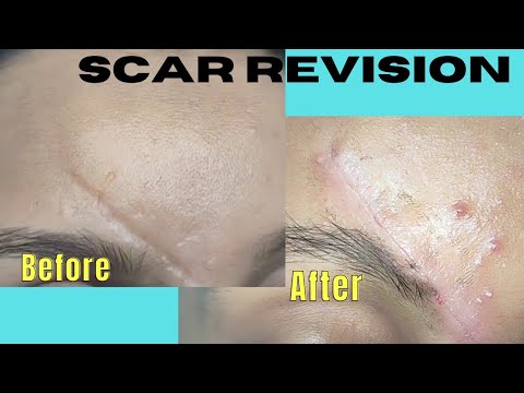 Forehead scar , 1 week after scar revision surgery| Laser scar revision ...