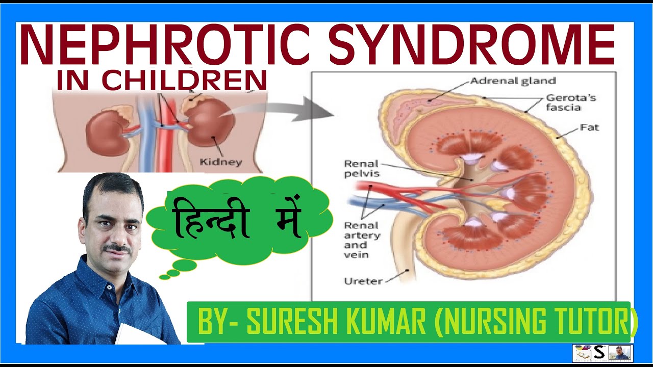 बच्चों में नेफ्रोटिक सिंड्रोम के बारे में पूरी जानकारी | NEPHROTIC ...