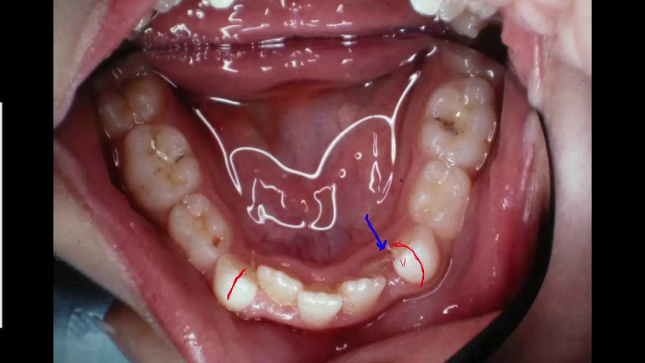 the slicing technique - YouTube