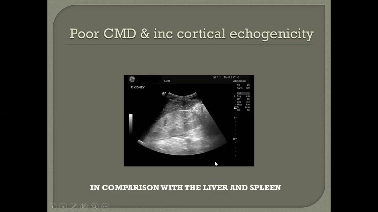 Role of Ultrasound in HIVAN - YouTube