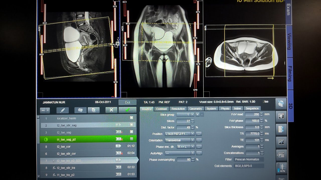 MRI Pelvis | CA Cervix MRI Protocol & Planning Tutorial (SIEMENS 1.5T ...