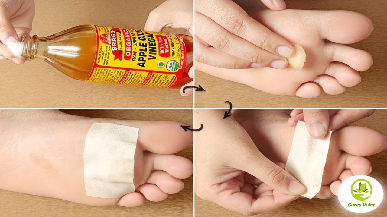 How to Get Rid of Calluses on Feet Naturally - Calluses on Feet ...