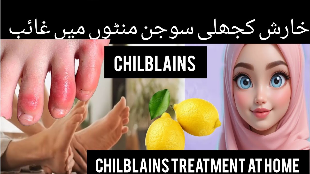 kharsh khujali sujan Ka illage#Best solution for chill blains || # ...