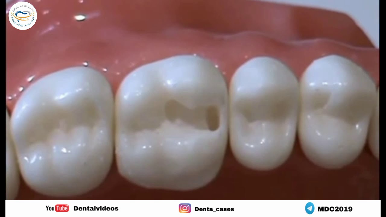 Class 2 cavity preparation - YouTube