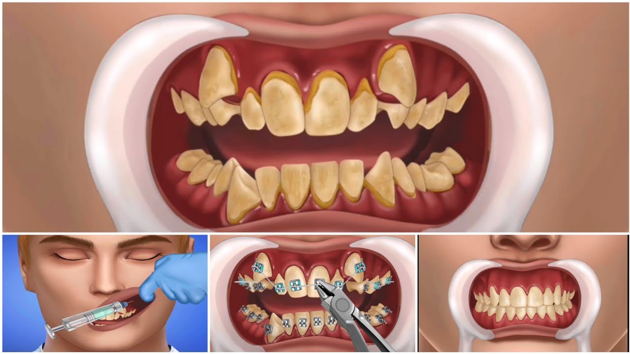 ASMR dental treatment animation | teeth treatment asmr | Braces ...