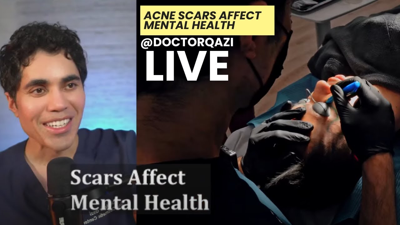 Dr. Qazi discusses how Acne Scars can Affect Mental Health | Dr. Qazi Unsponsored Live | 11.21. ...
