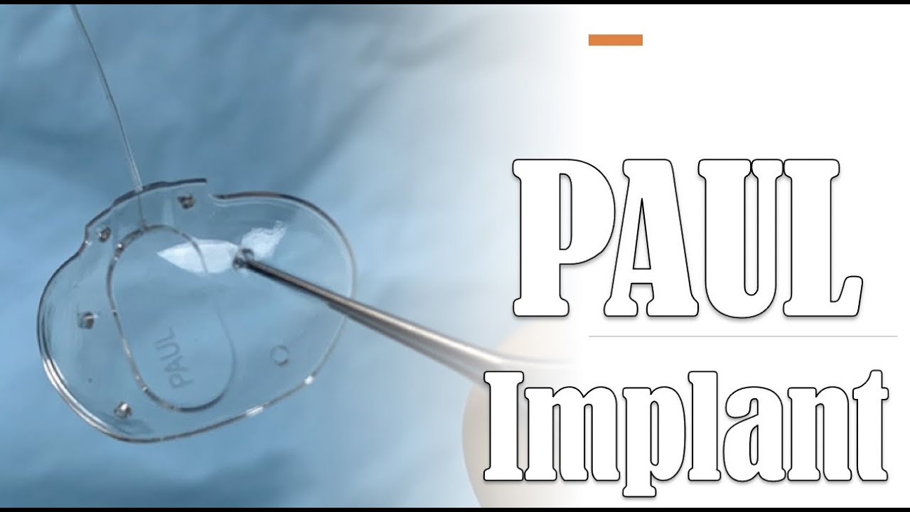 PAUL implant - YouTube