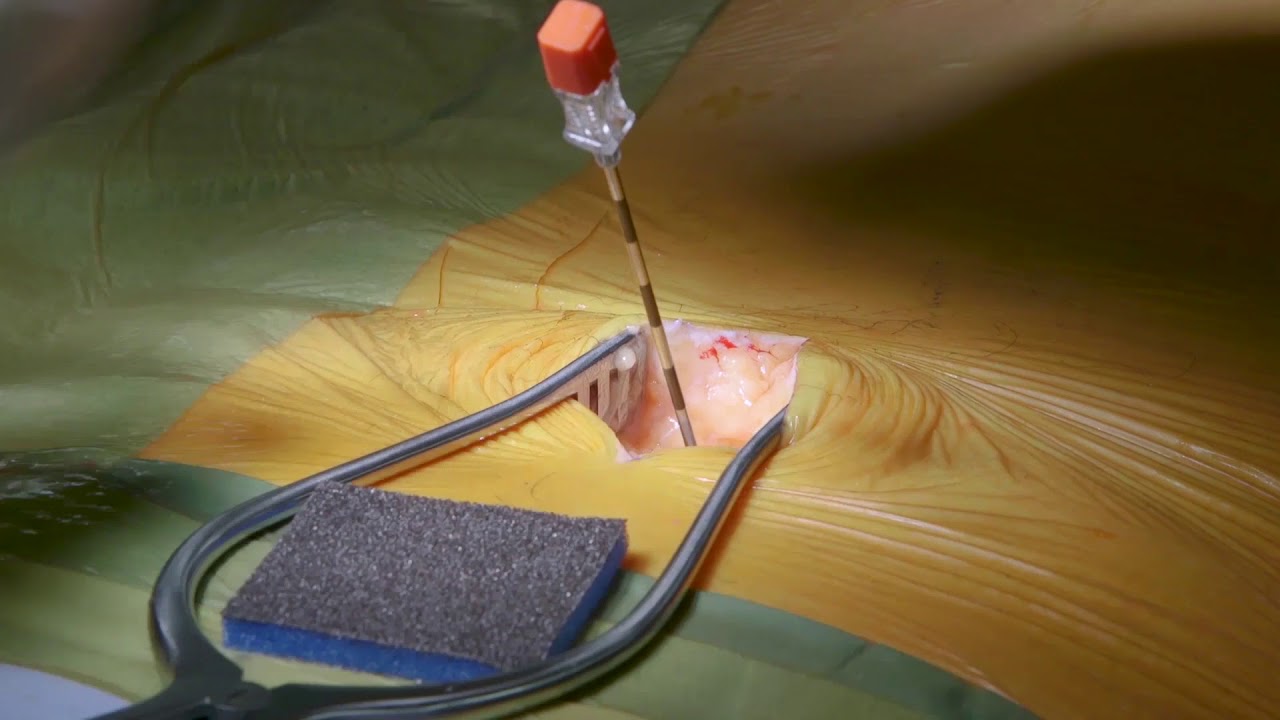 Pain and Spine Specialists - Prometra II Implant Procedure - YouTube