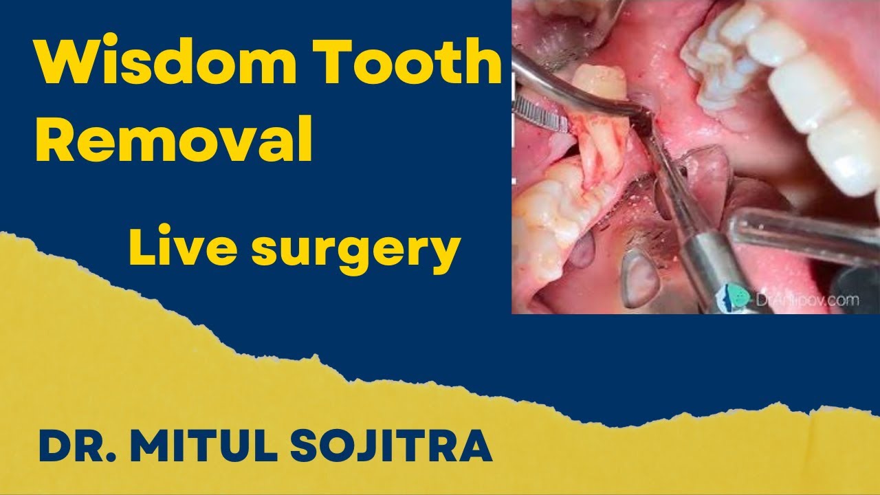 Wisdom tooth removal in 5 MIN or less || akal daad ke dard ka ilaj ...