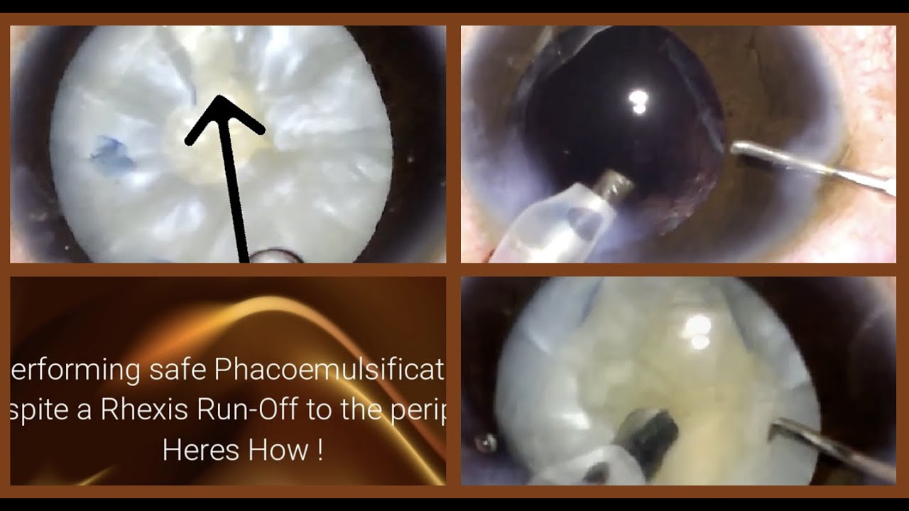 Performing safe phacoemulsifiation in spite of a rhexis run off to the ...