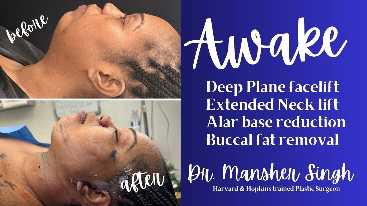 AWAKE Deep Plane Facelift | Extended Neck Lift | Buccal Fat Reduction ...