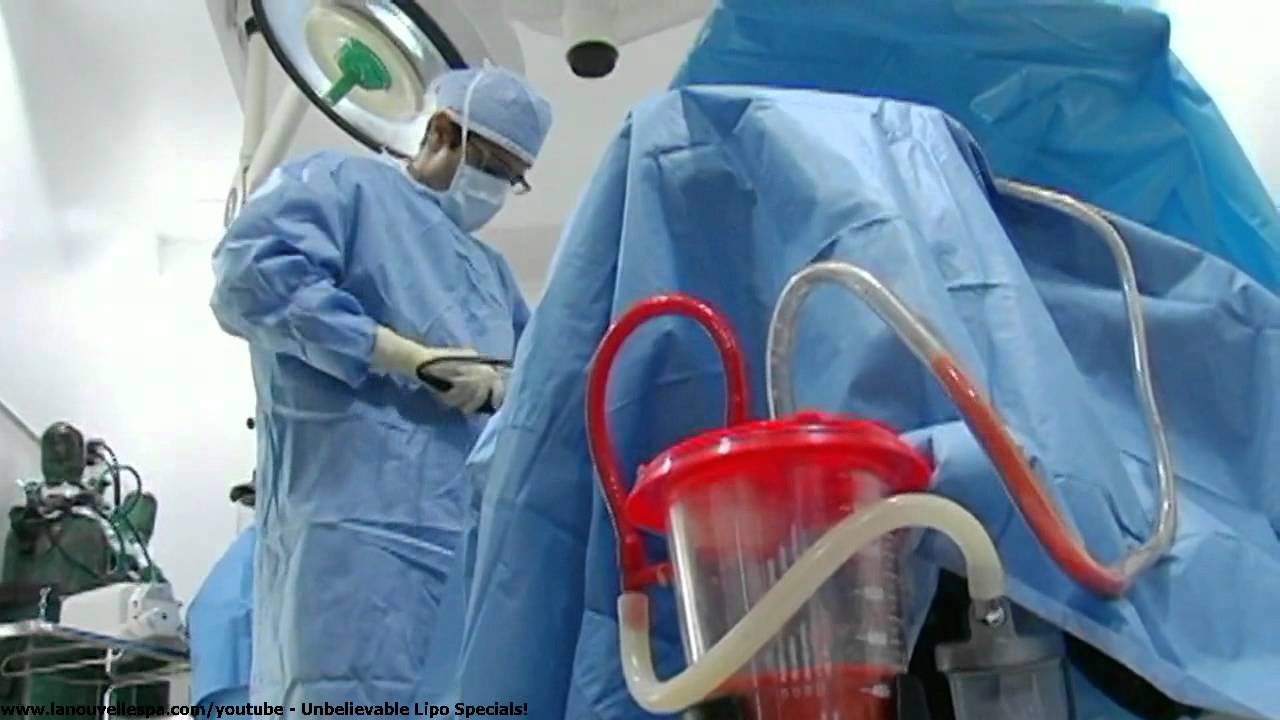 Beverly Hills Liposuction and Liposculpture Before and After - YouTube