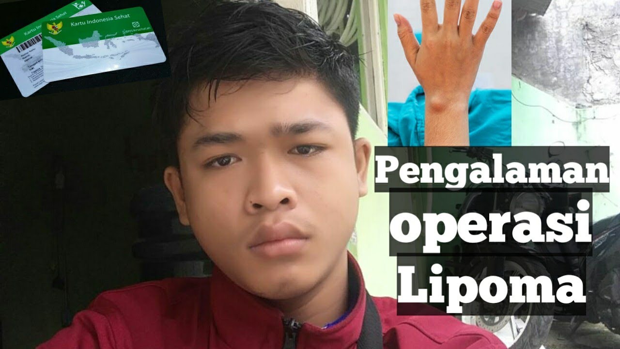 Cara Daftar Operasi Lipoma Pakai Kartu Indonesia Sehat | GrattiZz - YouTube