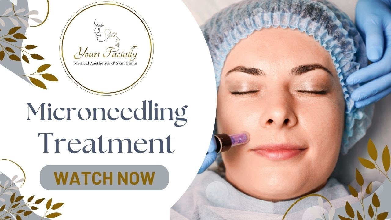Medical Microneedling - Yours Facially Aesthetics