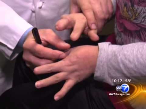 Rare Finger Transplant At Midwest Orthopaedics At Rush - YouTube