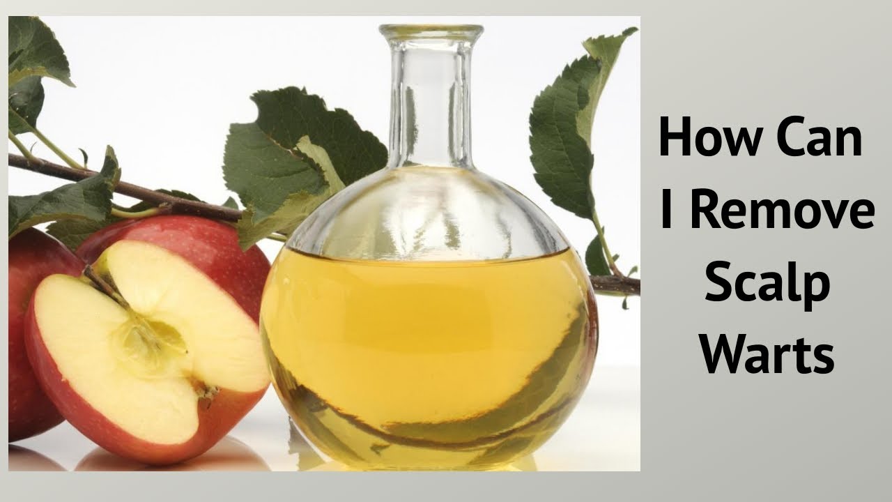 How Can I Remove Scalp Warts - YouTube