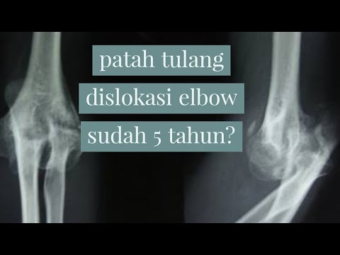 patah tulang dislokasi elbow, siku sudah 5 tahun - YouTube