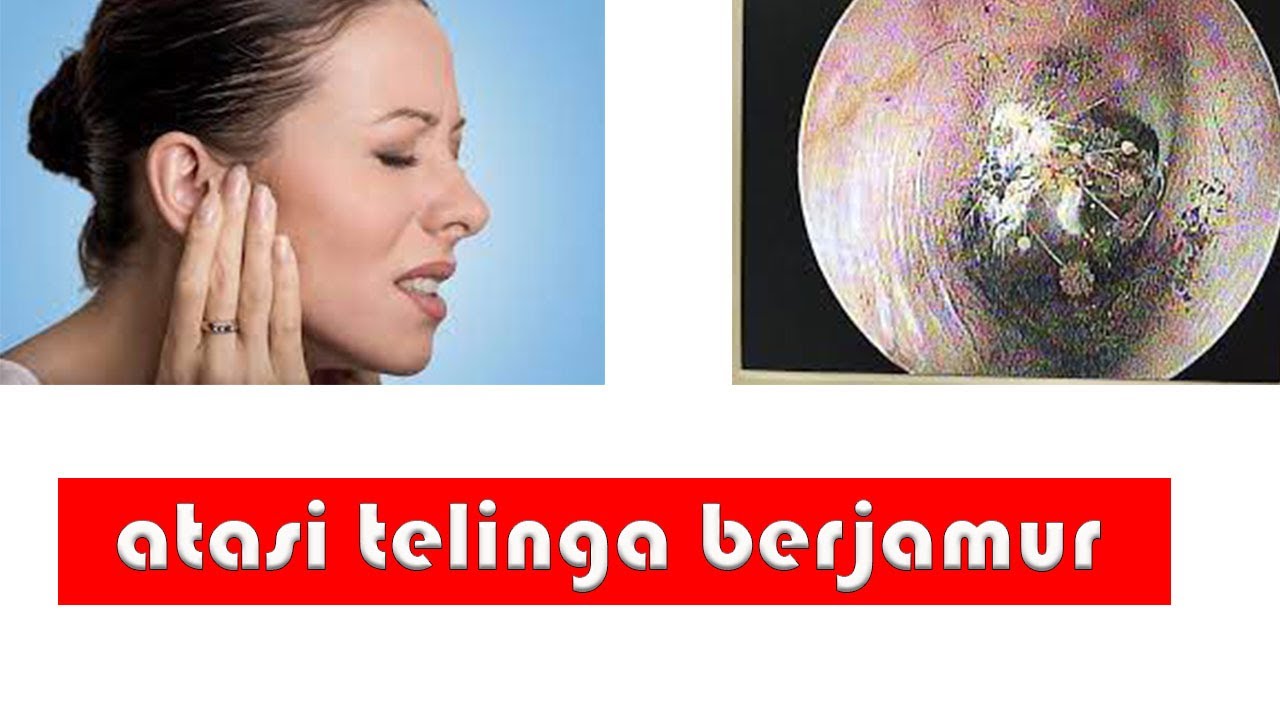 CIRI TELINGA BERJAMUR || PENYEBAB TELINGA BERJAMUR || CARA MENGATASI ...