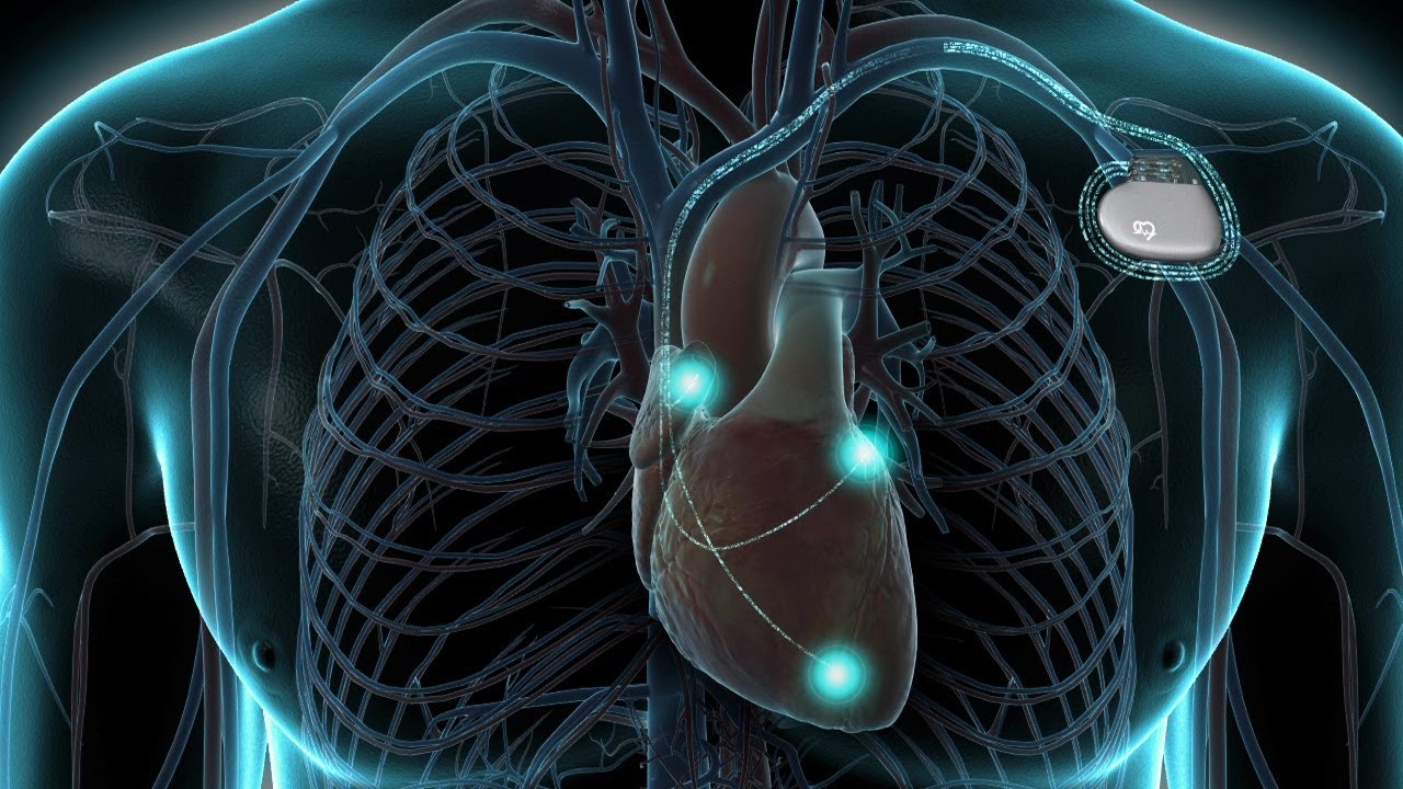 Electrical Storm and ICD Therapy: An Overview Update - YouTube