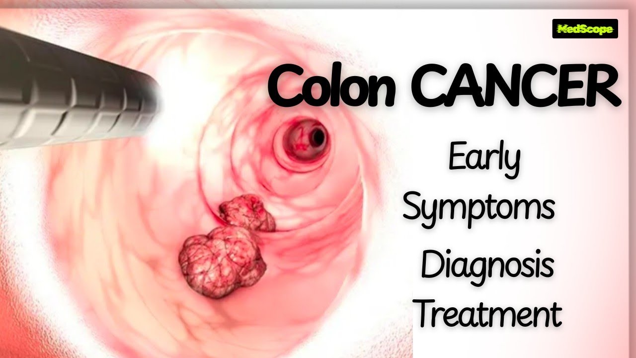 What Are The EARLY Signs Of Colon Cancer? - YouTube