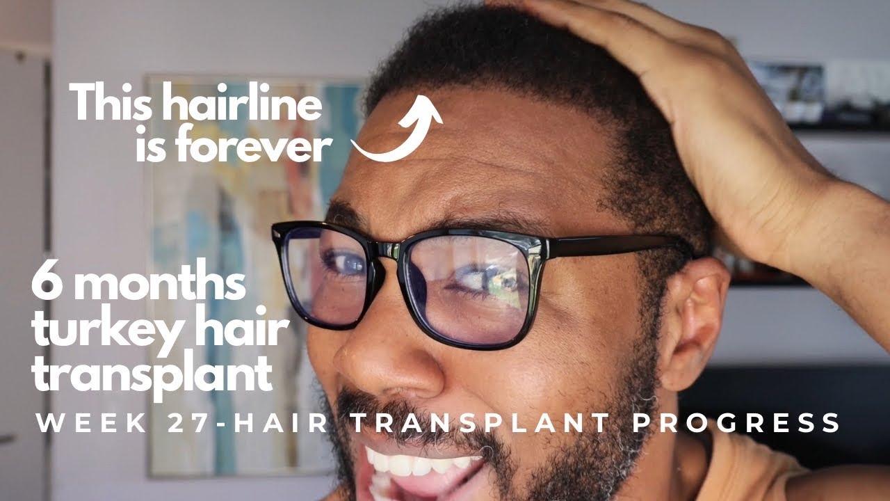 Week 27 - ( month 6 ) Turkey Hair transplant. Sharpest hairline on the ...
