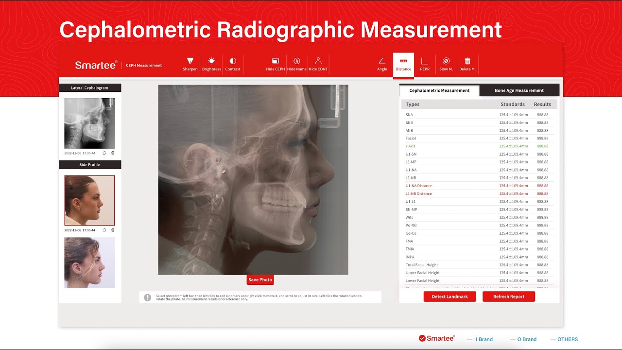 Smartee CEPH Measurement - YouTube